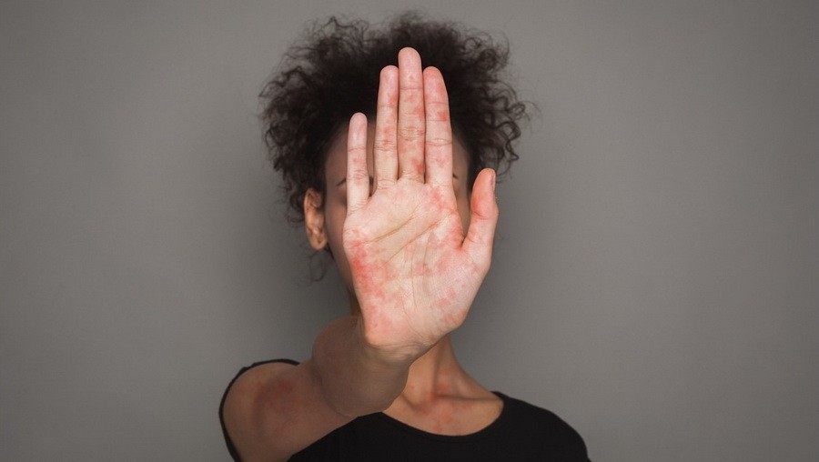 Saveti - Autoimune bolesti | Priroda na dar - Srbija